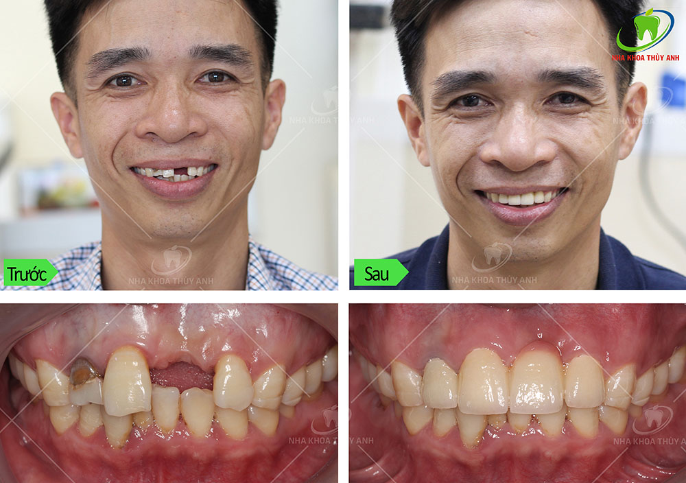 CẦU RĂNG SỨ LÀ GÌ? - nhakhoathuyanh