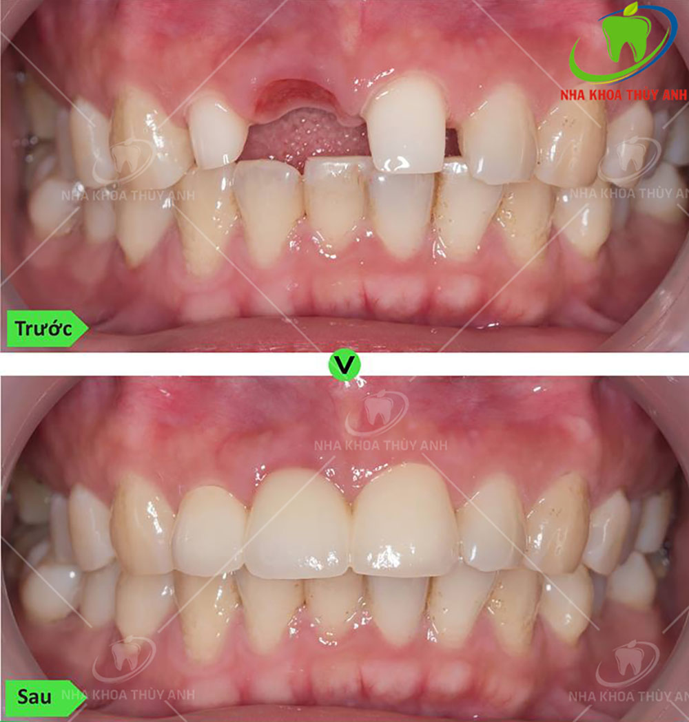 CẦU RĂNG SỨ LÀ GÌ? - nhakhoathuyanh