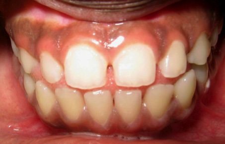 What should I do if my teeth are protruding outside the bone while ...