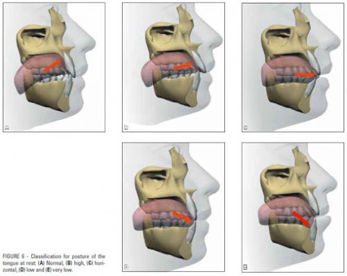 Bài tập Mewing giúp khắc phục tình trạng niềng răng bị hóp má, thái ...