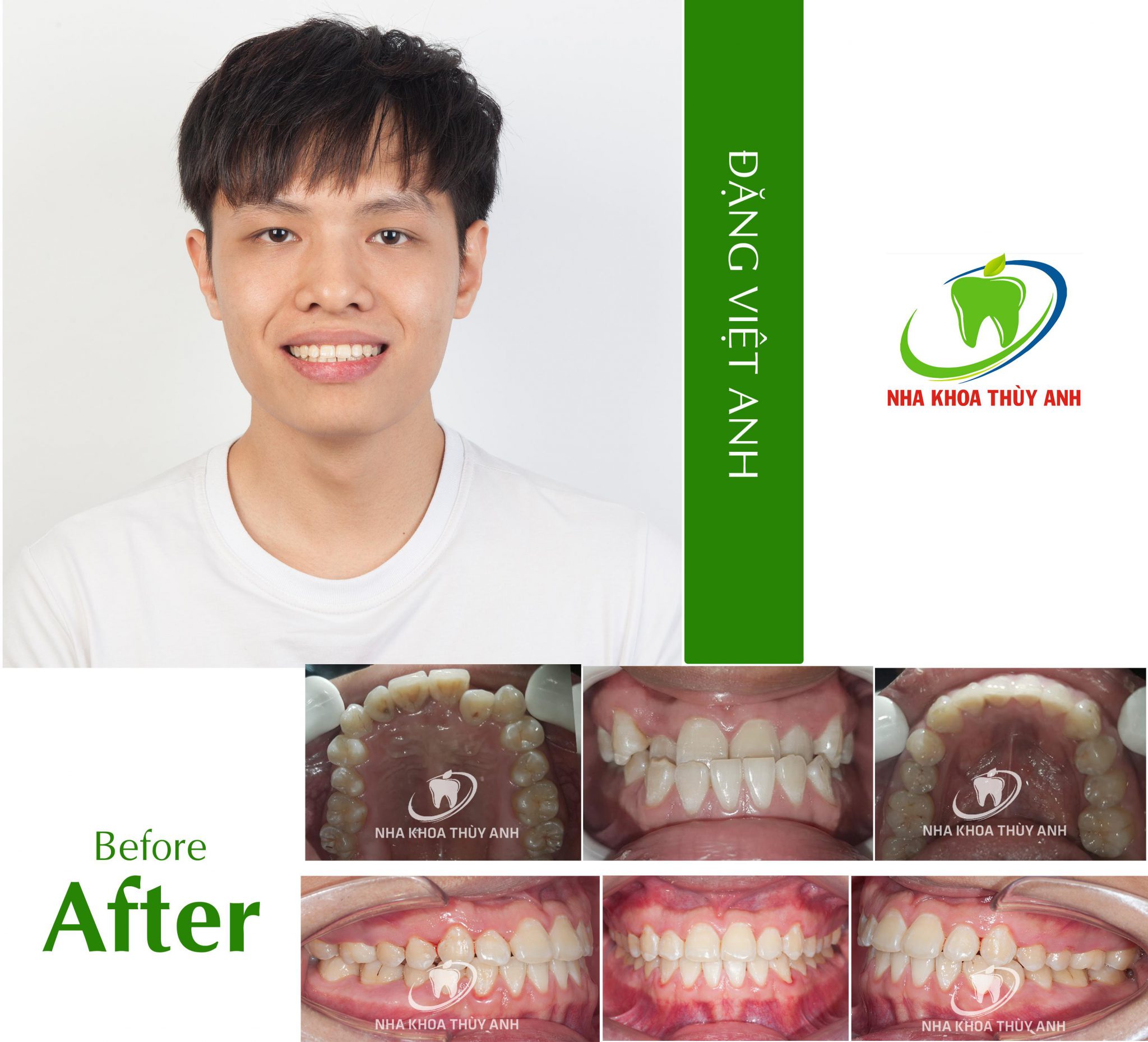 What is the most effective way to treat misaligned teeth? Thuy Anh ...
