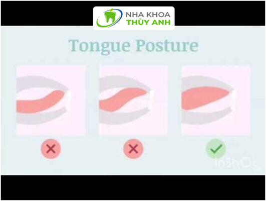 Hướng dẫn tập Mewing đúng cách cho người mới bắt đầu