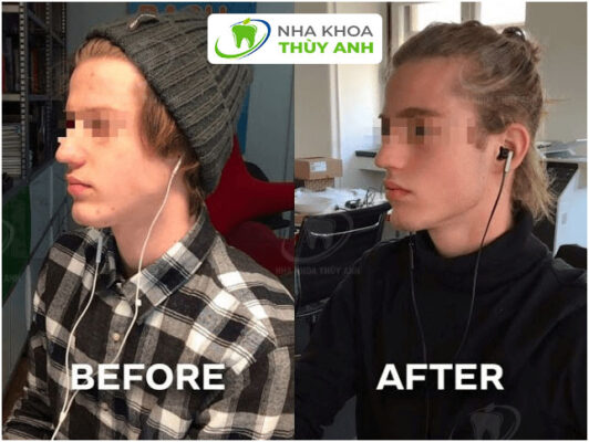 Hướng dẫn tập Mewing đúng cách cho người mới bắt đầu