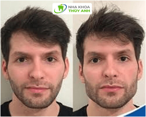 Hướng dẫn tập Mewing đúng cách cho người mới bắt đầu