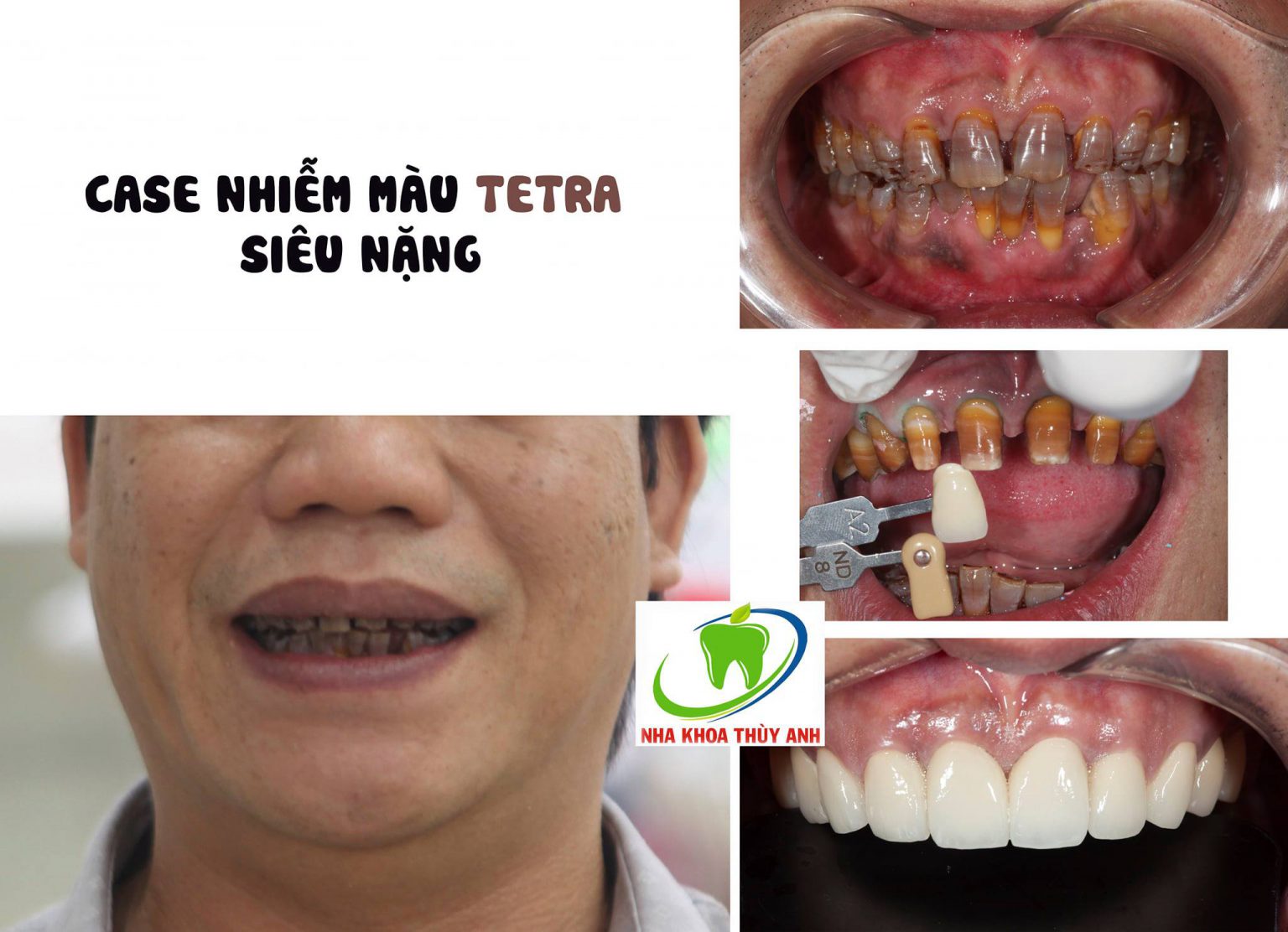 Răng cửa bị đen bên trong? Cách khắc phục an toàn và hiệu quả