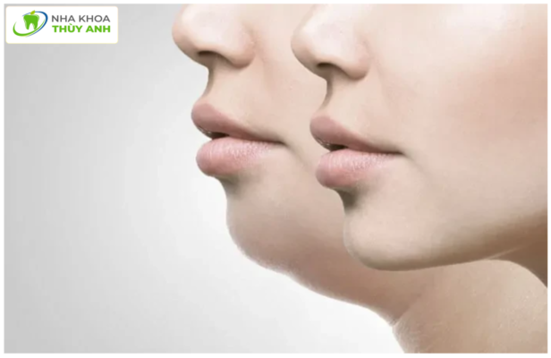 Mewing là gì? Mewing giúp thay đổi gương mặt như thế nào?