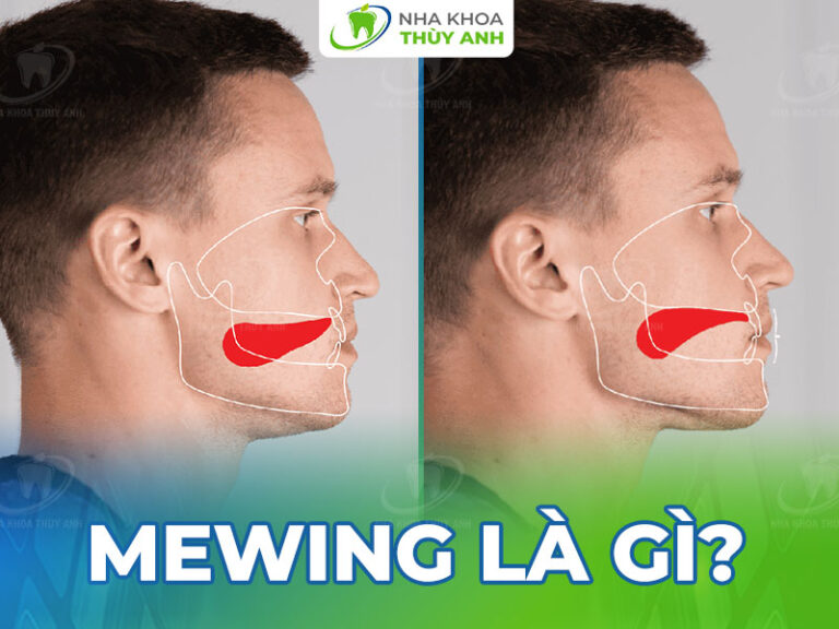 Mewing là gì? Mewing giúp thay đổi gương mặt như thế nào?