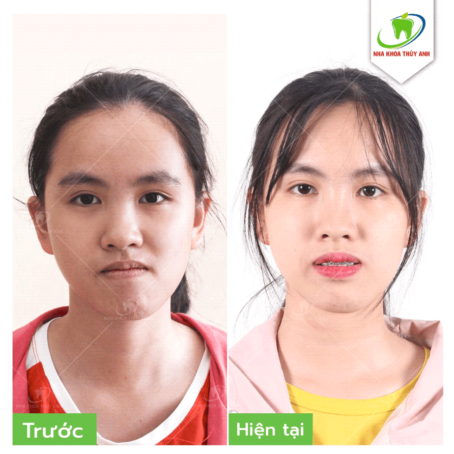 Sức mạnh của chỉnh nha không phẫu thuật với kỹ thuật Meaw, Geaw ...