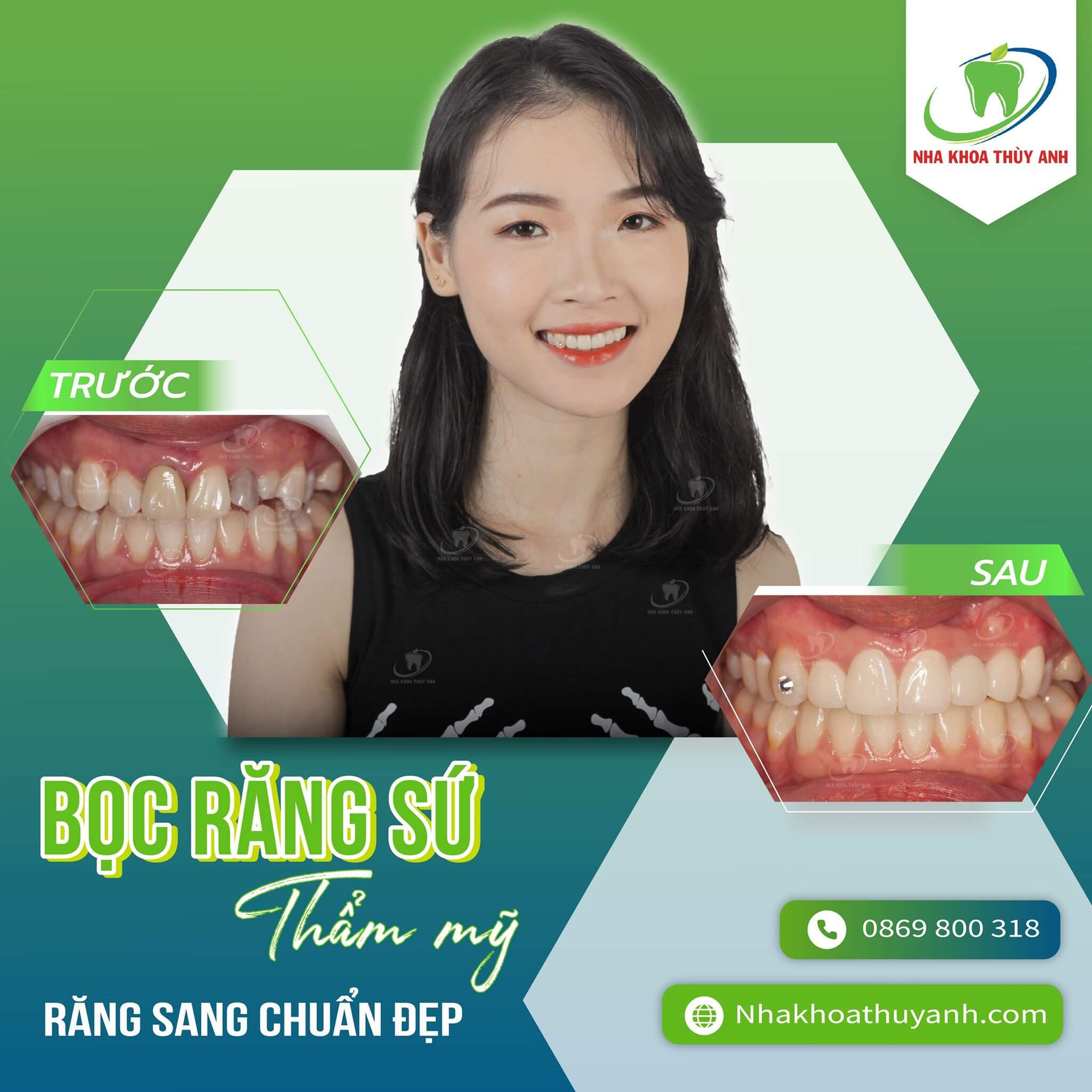 Chân răng bị đen: Nguyên nhân và hướng điều trị hiệu quả - nhakhoathuyanh