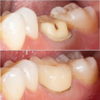 Bí quyết lựa chọn giữa bọc sứ và inlay sứ phục hồi răng sâu vỡ lớn ...