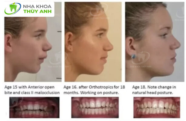 Kết quả tập mewing before after update nghiên cứu mới nhất