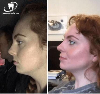 Kết quả tập mewing before after update nghiên cứu mới nhất