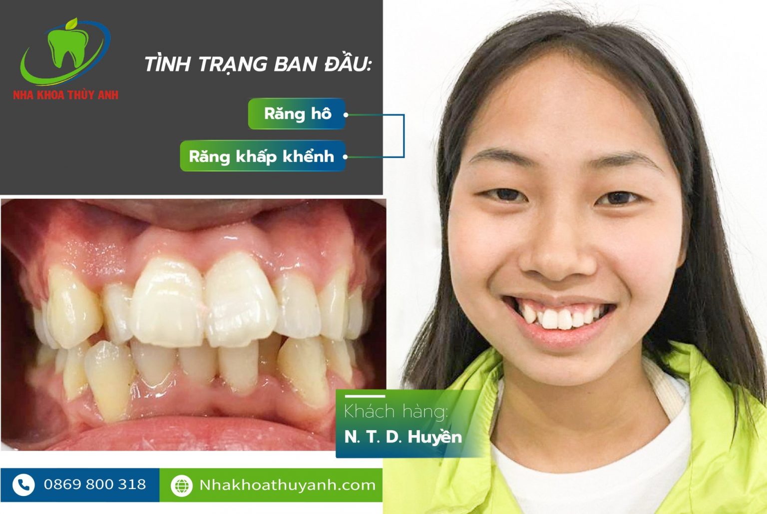 Hô răng và hô hàm: Hướng dẫn cách nhận biết và điều trị