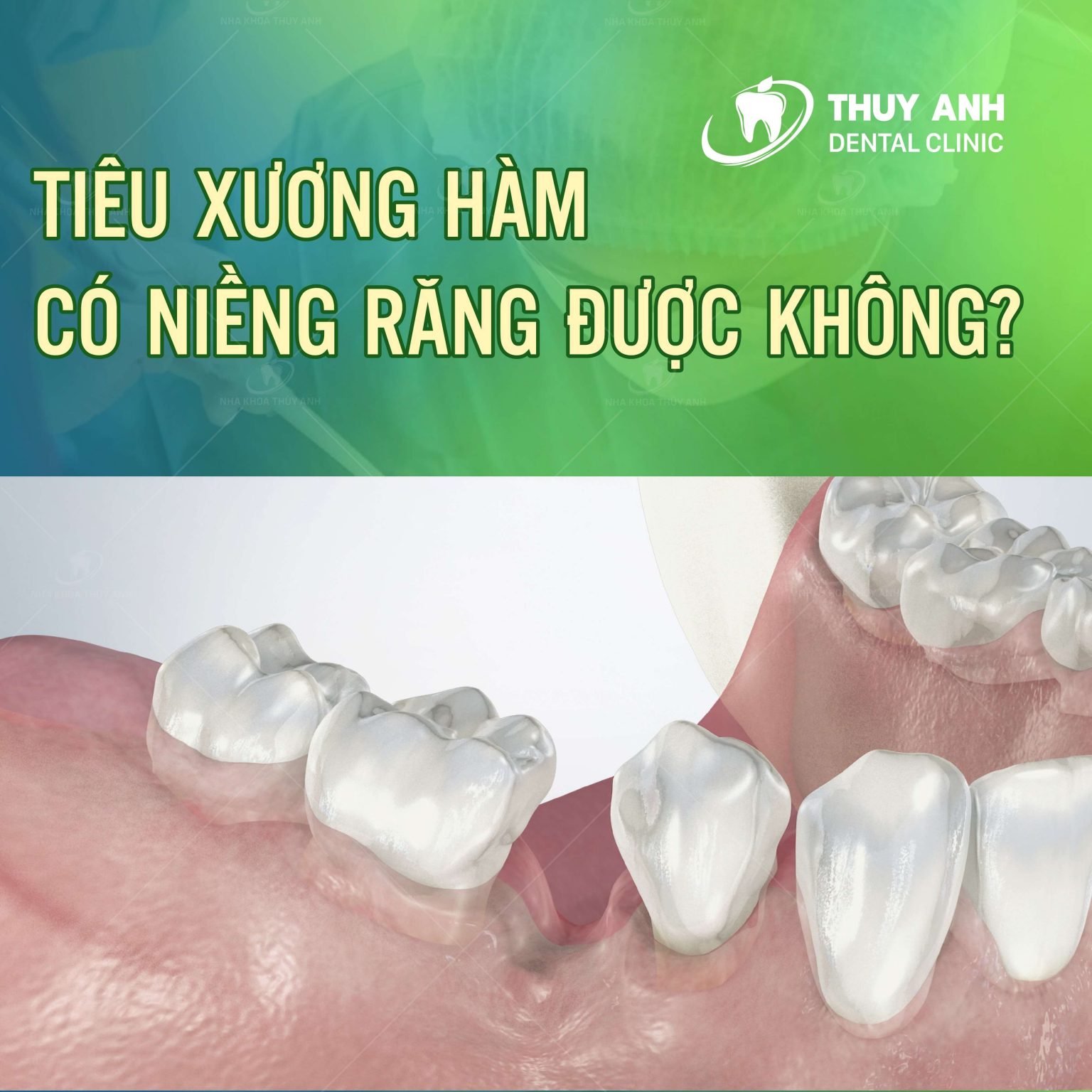 Niềng răng nhổ răng số 4 và những điều bạn cần nắm rõ