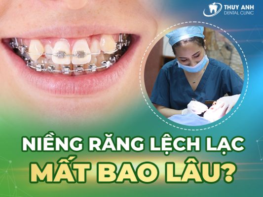 Niềng răng mắc cài sứ giá bao nhiêu? Chi phí tốt nhất năm
