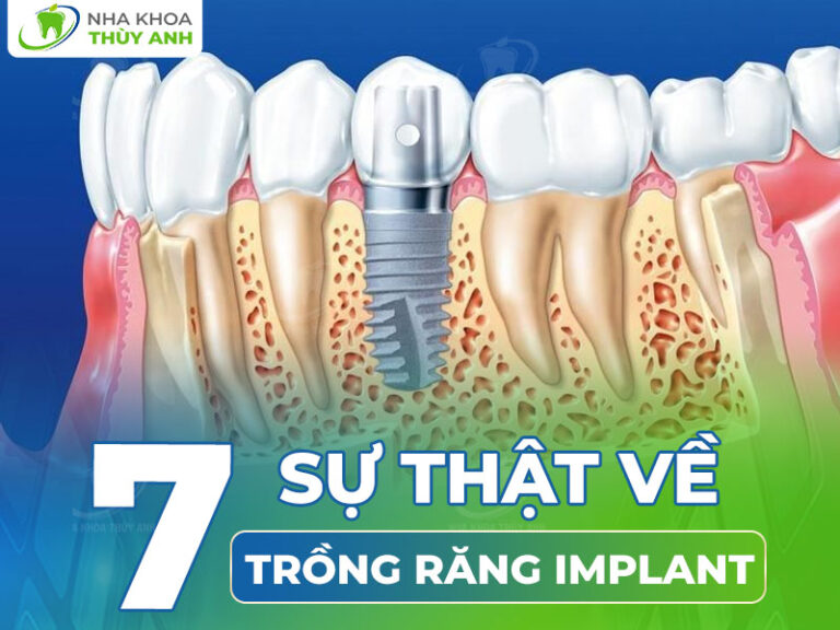Có nên trồng răng implant không? 7 sự thật về răng implant