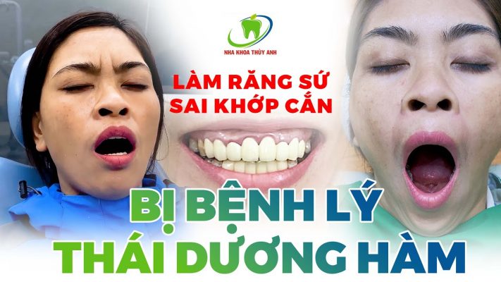 Bị viêm khớp thái dương hàm sau khi làm răng sứ và cách chữa trị đúng ...