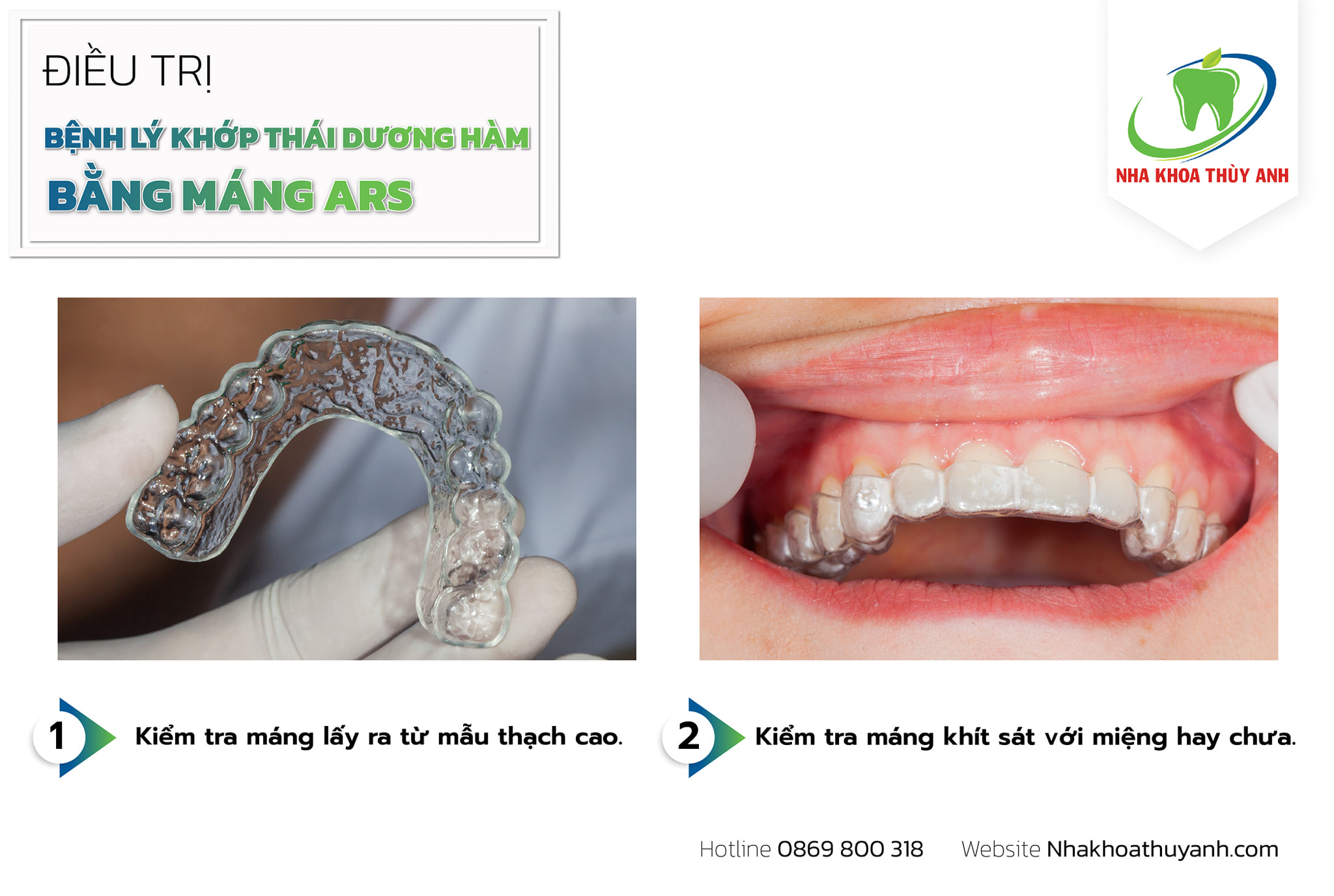 17 bước làm máng nhai điều trị viêm khớp thái dương hàm - nhakhoathuyanh