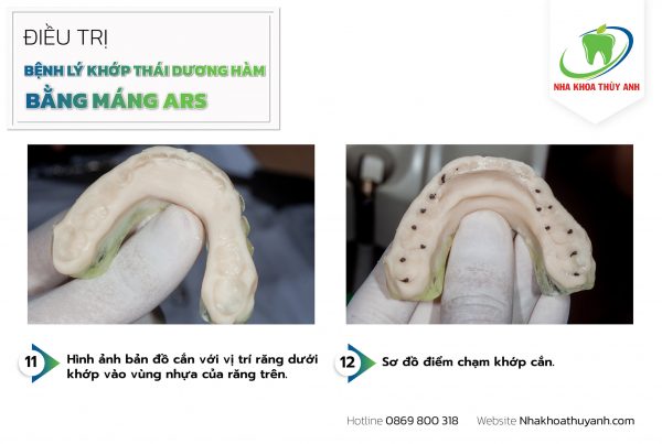 17 bước làm máng nhai điều trị viêm khớp thái dương hàm - nhakhoathuyanh