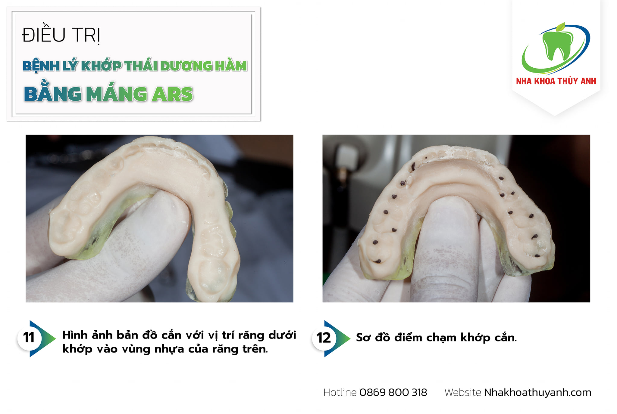 17 bước làm máng nhai điều trị viêm khớp thái dương hàm - nhakhoathuyanh