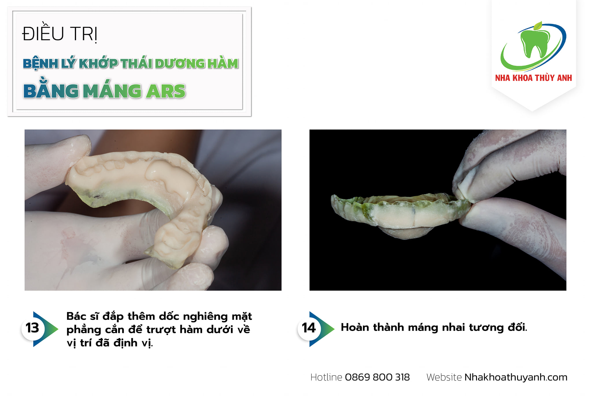 17 bước làm máng nhai điều trị viêm khớp thái dương hàm - nhakhoathuyanh