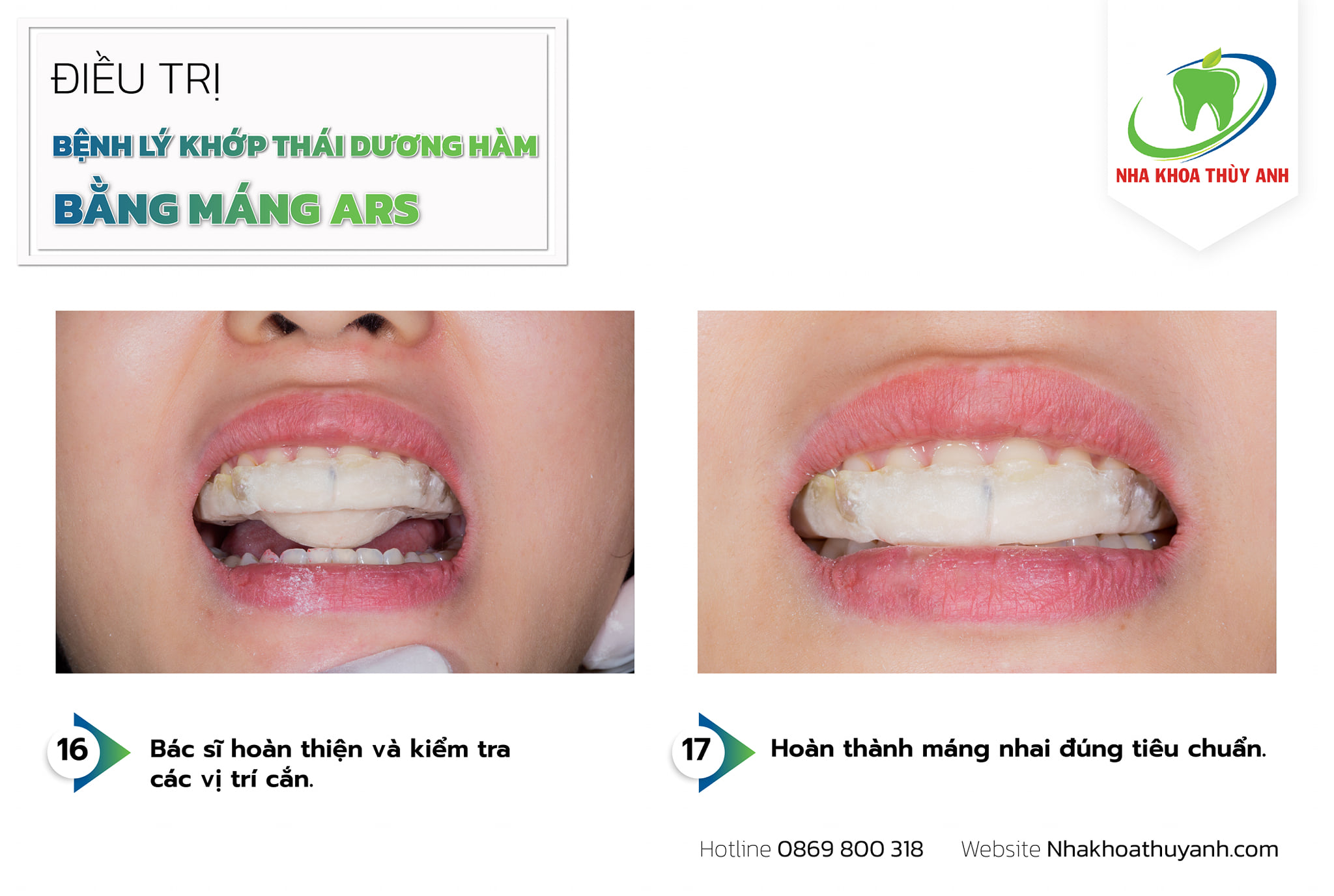 17 bước làm máng nhai điều trị viêm khớp thái dương hàm - nhakhoathuyanh