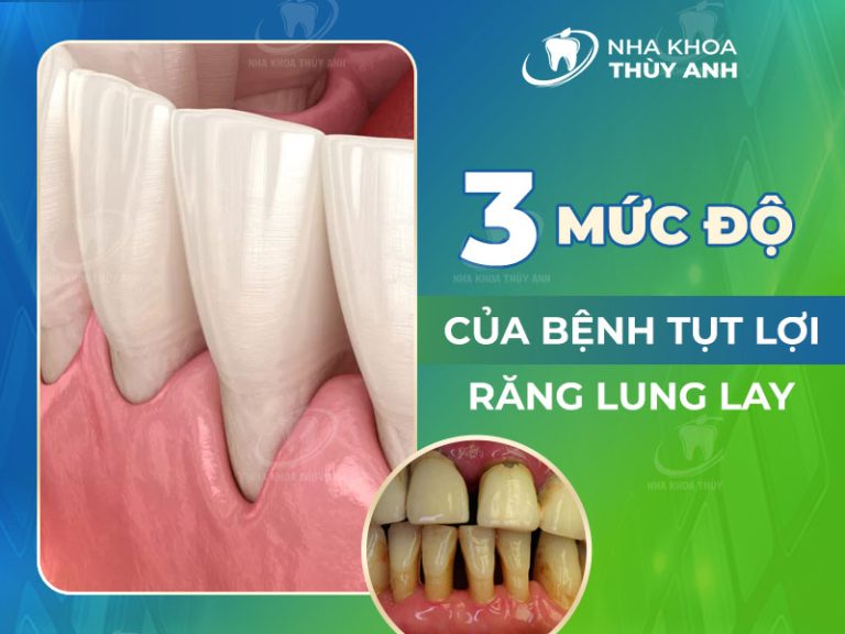 Tụt lợi răng lung lay có những giai đoạn nào? Nha khoa Thùy Anh