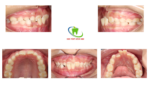 Khớp cắn chéo điều trị như thế nào cho an toàn và hiệu quả