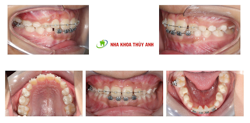 Khớp cắn chéo điều trị như thế nào cho an toàn và hiệu quả