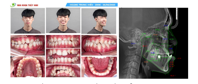 Khớp cắn chéo điều trị như thế nào cho an toàn và hiệu quả