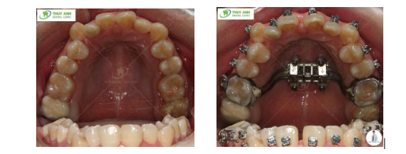 Khớp cắn chéo điều trị như thế nào cho an toàn và hiệu quả