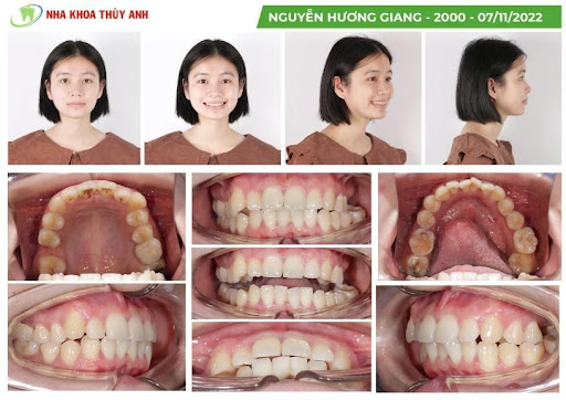 Khớp cắn chéo điều trị như thế nào cho an toàn và hiệu quả