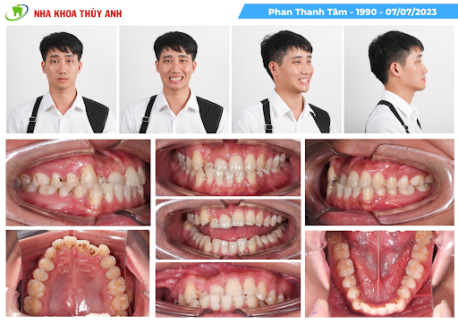 Khớp cắn chéo điều trị như thế nào cho an toàn và hiệu quả