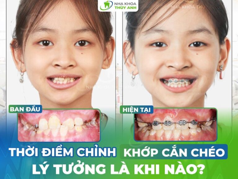 Khớp cắn chéo là gì? Phân biệt các dạng khớp cắn chéo