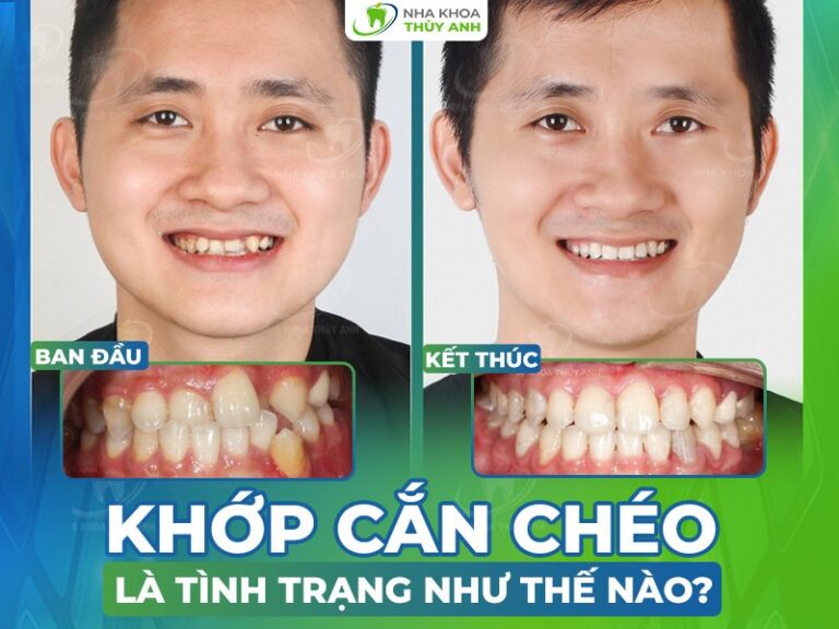 Khớp cắn chéo là gì? Phân biệt các dạng khớp cắn chéo