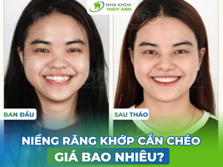 Khớp cắn chéo là gì? Niềng răng khớp cắn chéo bao nhiêu tiền?