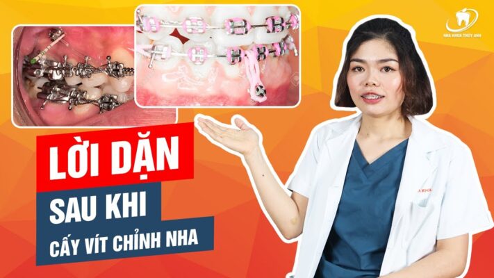 Niềng Răng: Viêm mini vis sau cấy, nguyên nhân và cách điều trị ...