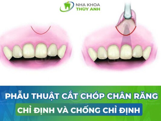 Phẫu thuật cắt chóp chân răng: Chỉ định và chống chỉ định - nhakhoathuyanh
