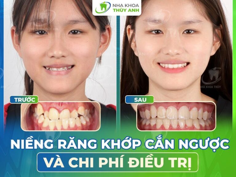 Reverse bite braces and reverse bite braces price