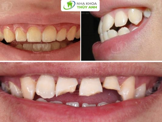 Porcelain crowns for 6 front teeth: When should they be crowned? Which ...