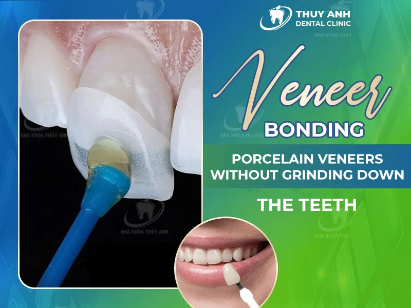 What are porcelain veneers? The procedure and treatment costs.