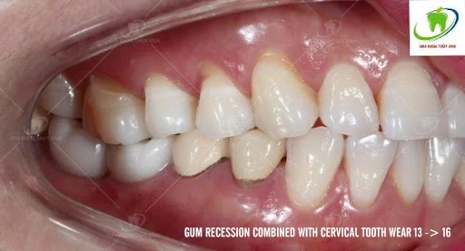 Receding gums and the most effective treatment solution
