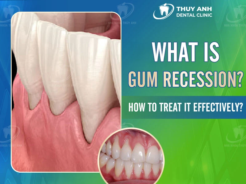 Receding gums and the most effective treatment solution