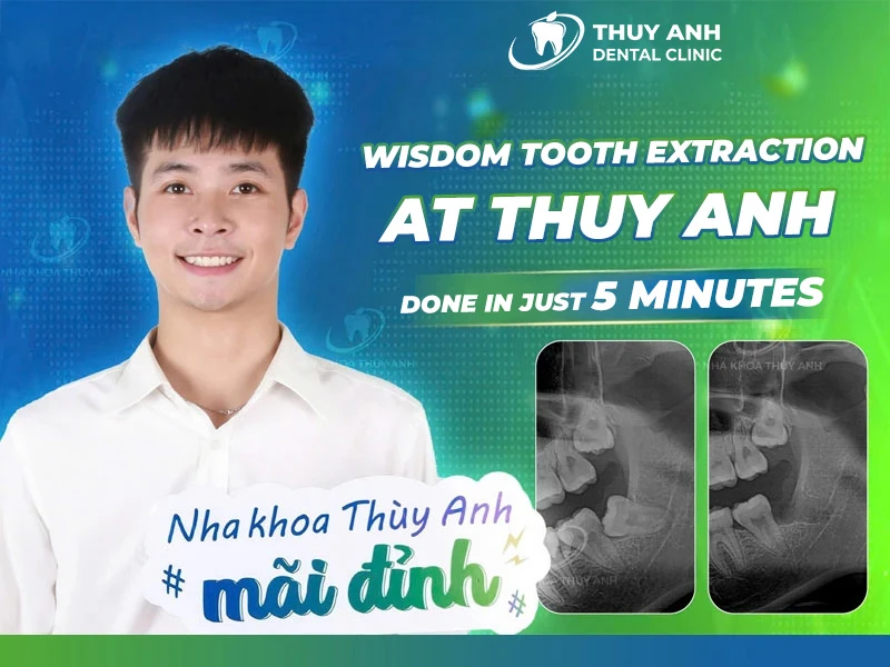 Gentle, precise, and pain-free wisdom tooth extraction
